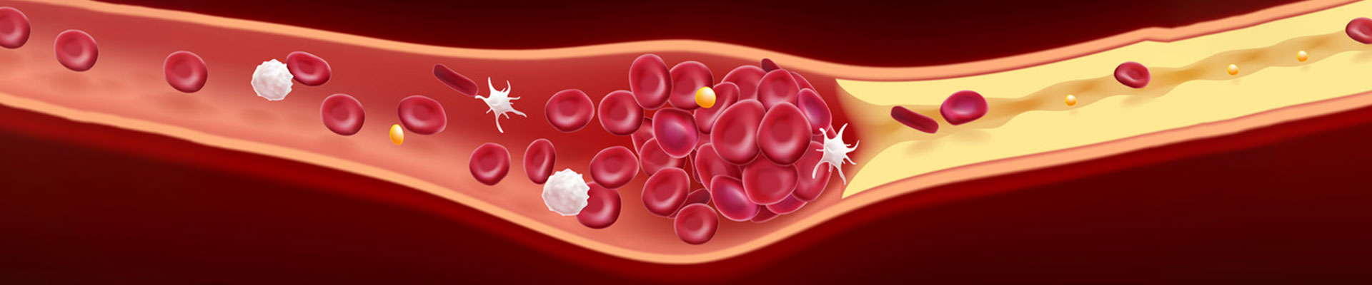 What is LDL cholesterol in a blood test? | HOD