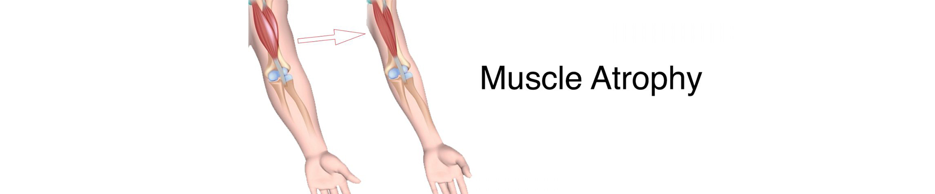 Muscle atrophy - Causes, Symptoms and Treatment | HOD